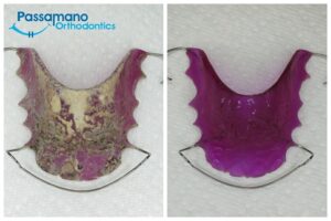 How To Clean a Crusty Retainer (Invisalign or Orthodontic) - Passamano ...