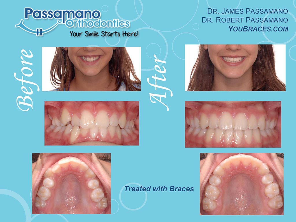 Lots of Crowding in Phase 1 to Extractions to Phase 2 Braces to ...