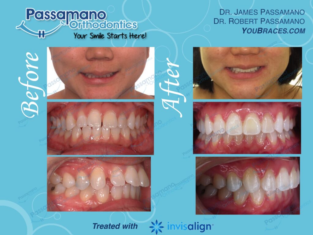 Flared Upper Incisors Fixed with Invisalign only No Extraction ...