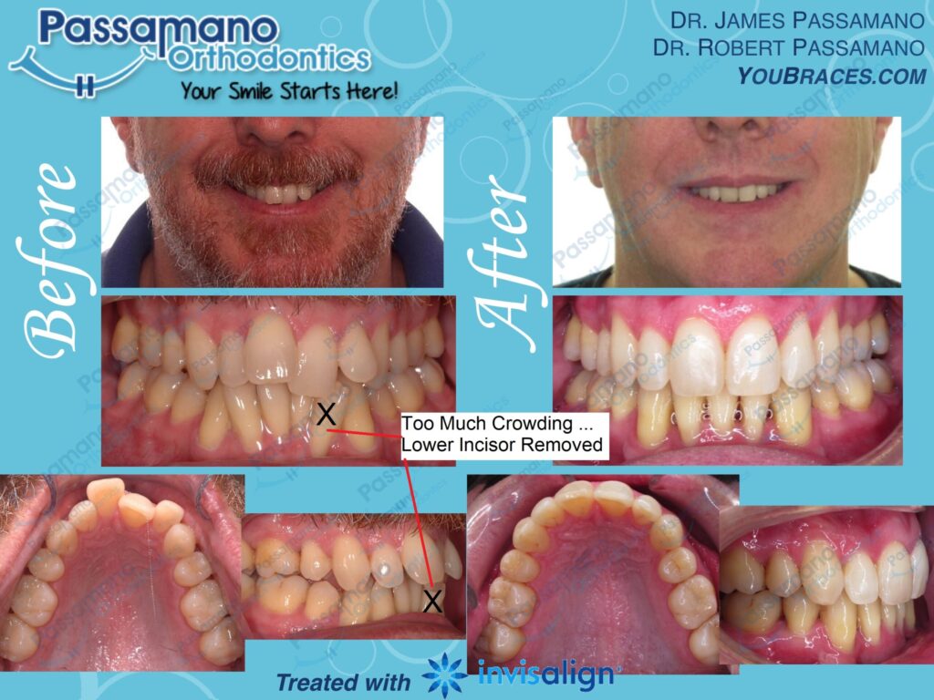 Adult Male Lower Incisor Extracted Lot of Crowding Awesome Result ...