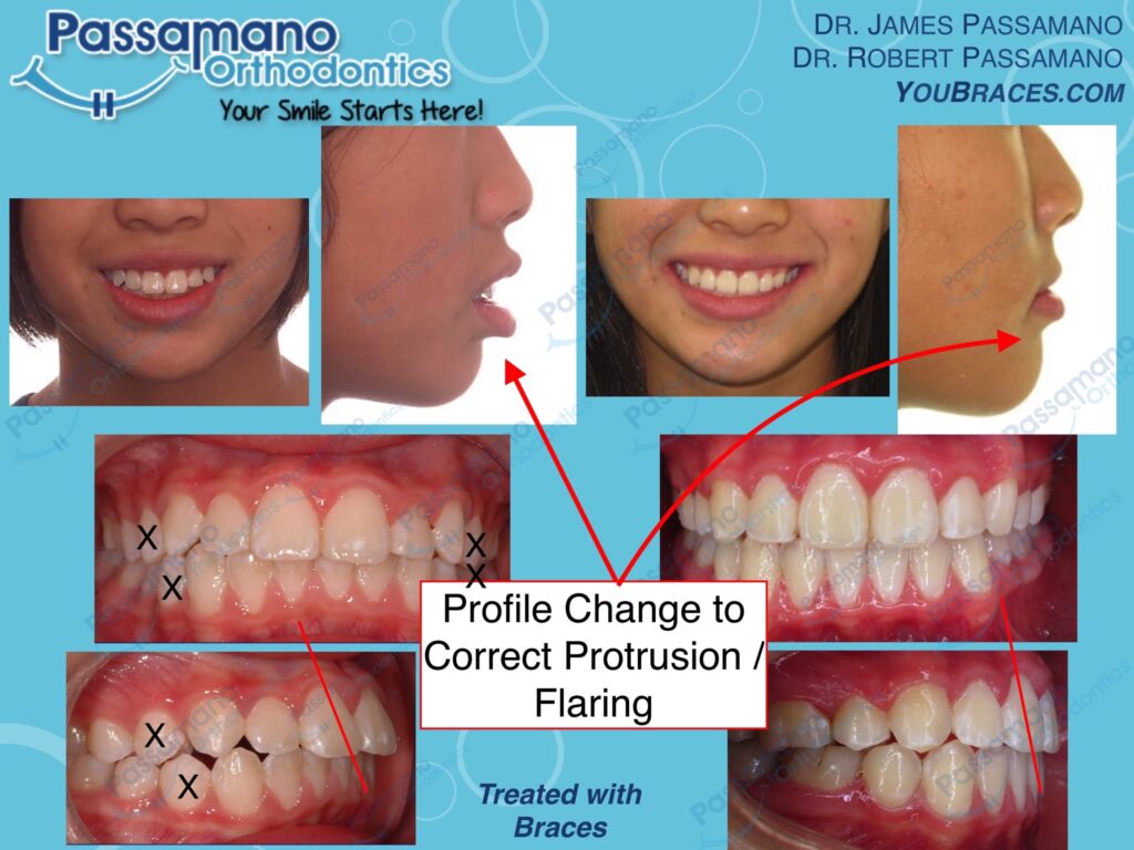 4 Premolar Teeth Extracted for AMAZING Profile and Lip Changes, A ...