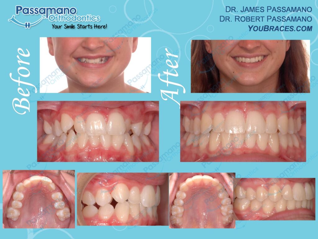 Teenage Female Midline Correction and Good Occlusion - Passamano ...