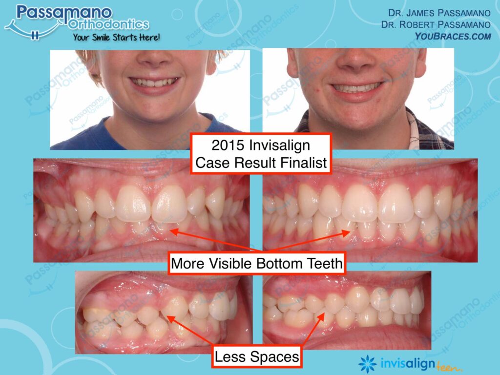 Invisalign Teenage Male Class 2 Correction - Passamano Orthodontics