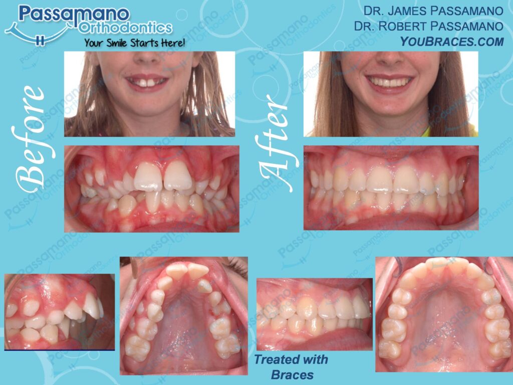 Bionator Smile Transformation Awesome Case - Passamano Orthodontics