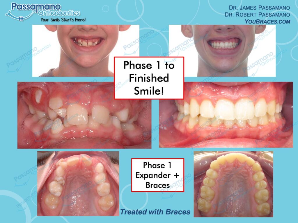 Phase 1 Crowding to Finished Smile at 14 years old - Passamano Orthodontics