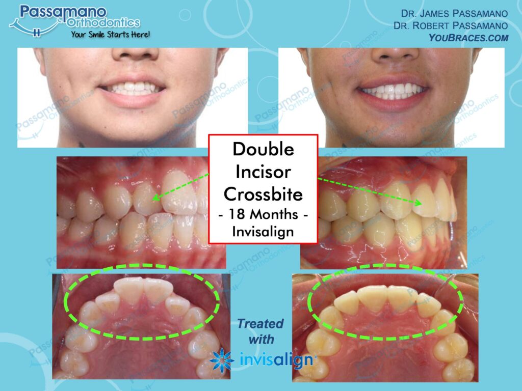 Double Incisor Crossbite Invisalign Teen Male - Passamano Orthodontics