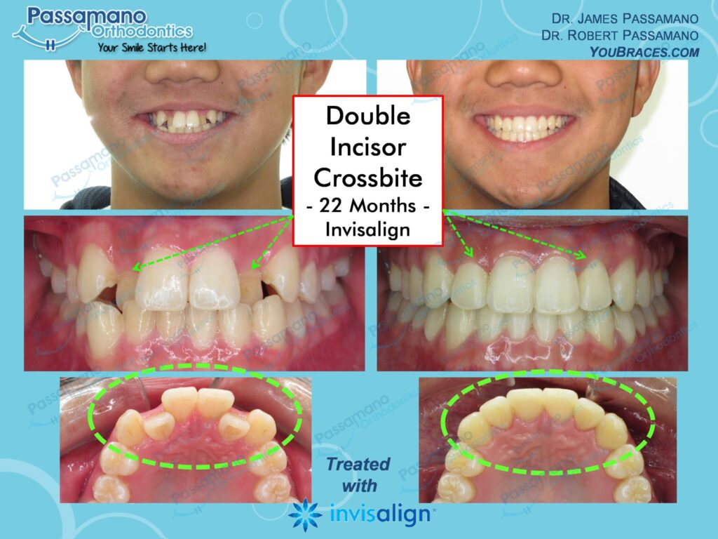 Double Incisor Crossbite Again Invisalign Teen Male - Passamano ...