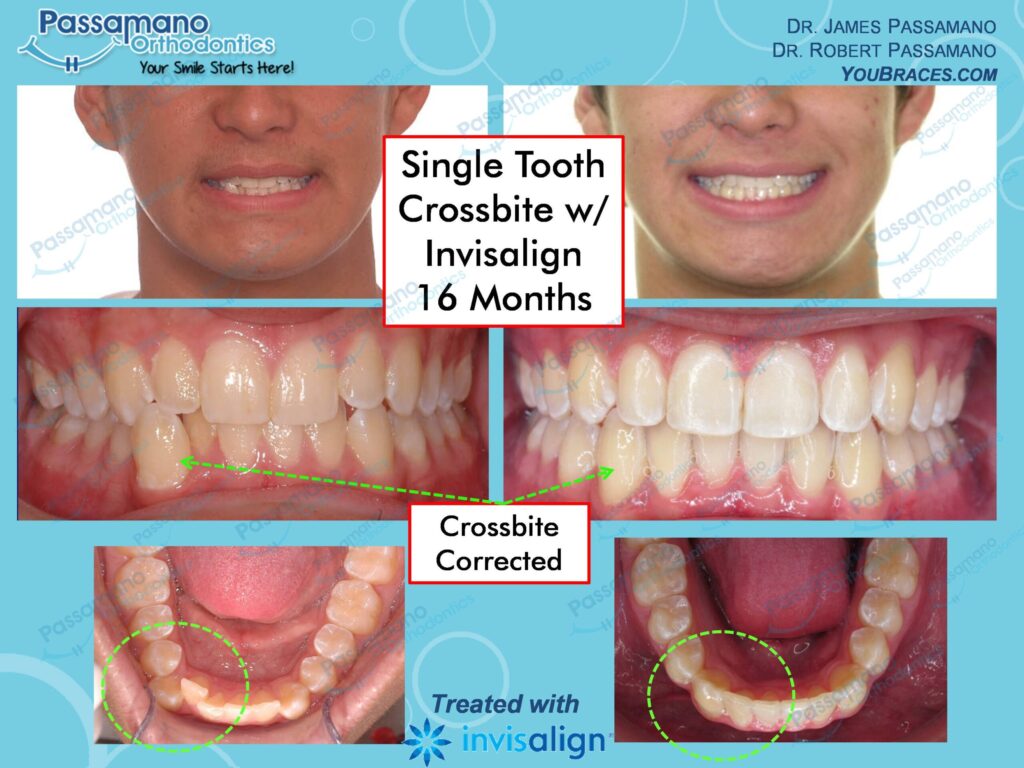 Single Tooth Crossbite 16 Year Old WOW - Passamano Orthodontics