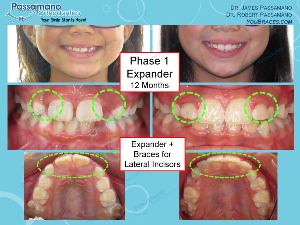 Phase 1 Expander and Braces for Blocked Out Laterals - Passamano Orthodontics