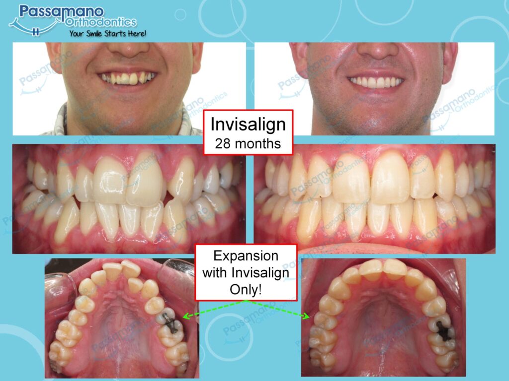 Invisalign Expansion Only 28 Years Old - Passamano Orthodontics
