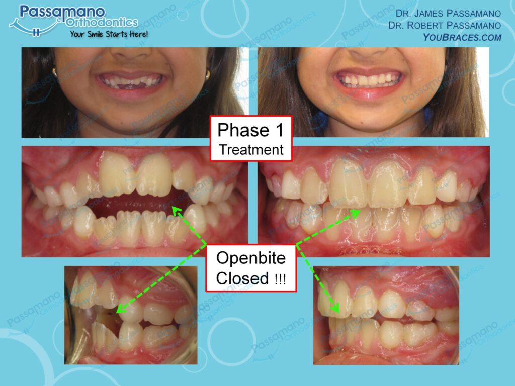 Phase 1 Open Bite Closed with Expander - Passamano Orthodontics