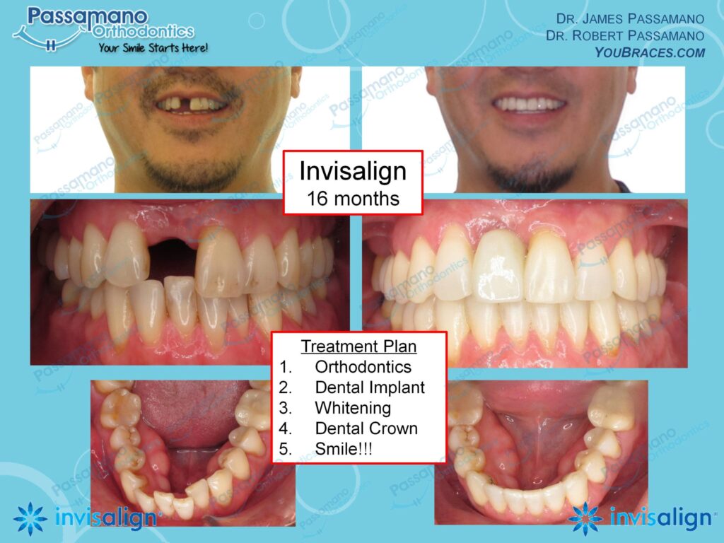 Missing Tooth Replaced with Implant Crown - Passamano Orthodontics