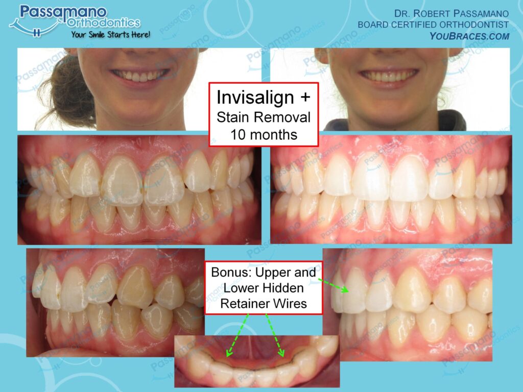 Permanent Hidden Retainer Wire Upper and Lower Crowding - Passamano ...