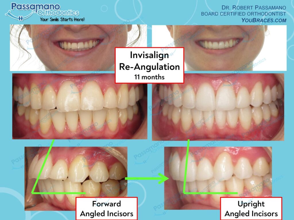 Forward Angulation Resolved with Invisalign and IPR - Passamano ...