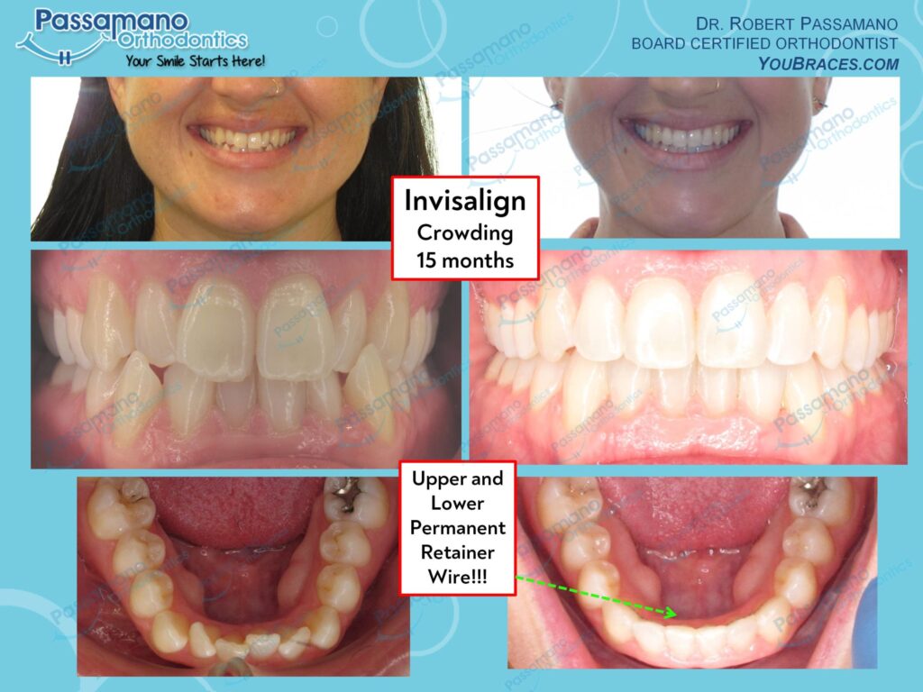 Adult Female Invisalign Crowding Plus Crossbites Great Finish ...