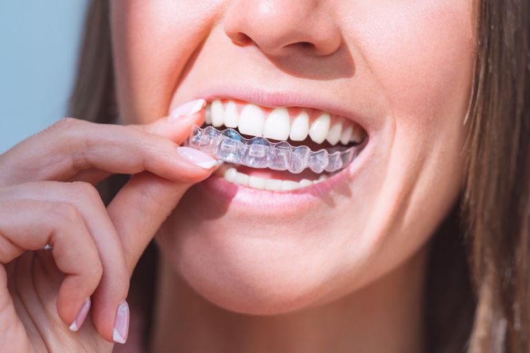 How to Whiten Your Teeth at Home with Clear Retainers or Invisalign Trays - Passamano Orthodontics